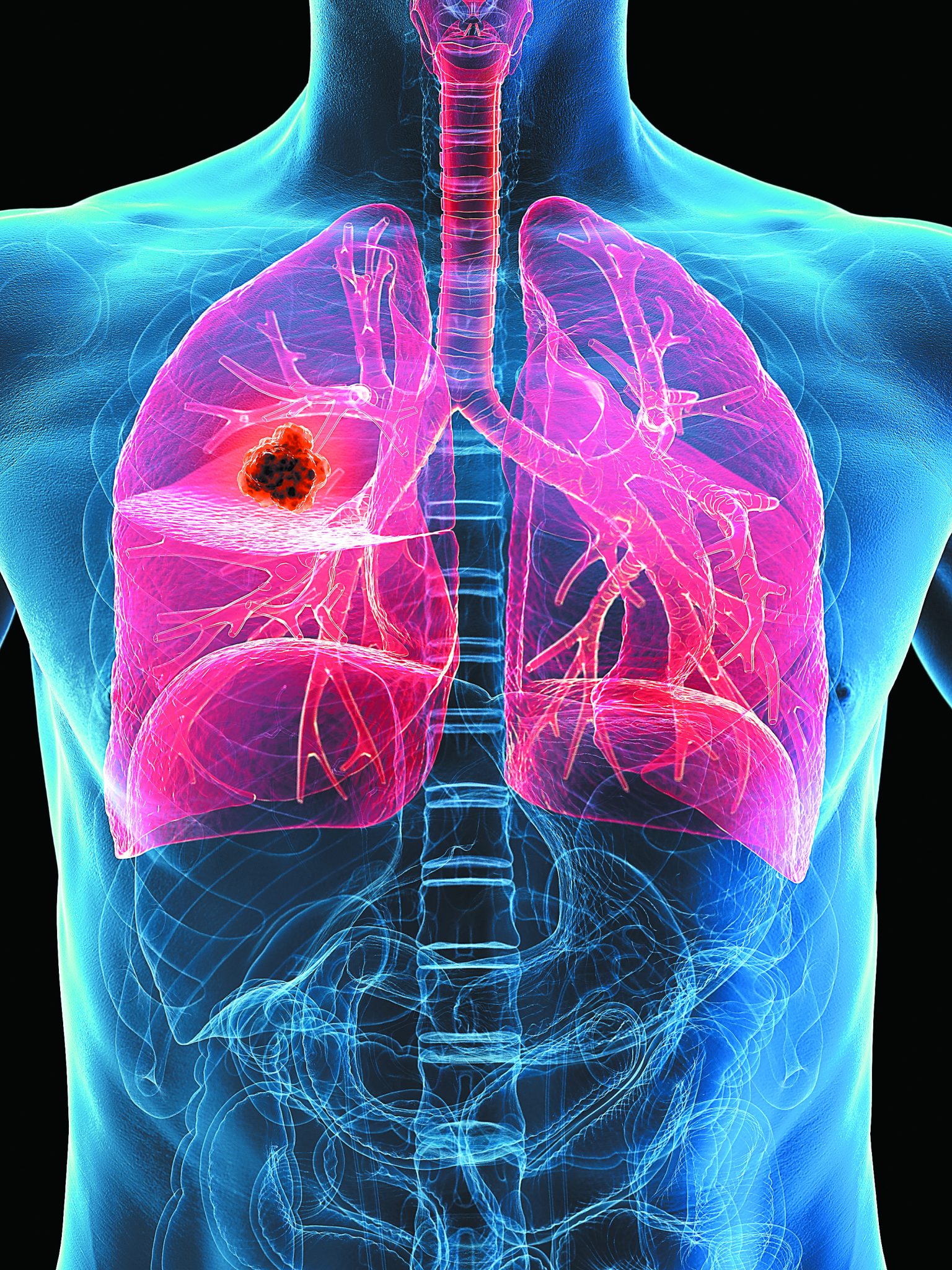 AI Tool Tracks Lung Tumors in Real Time With Every Breath - tovima.com